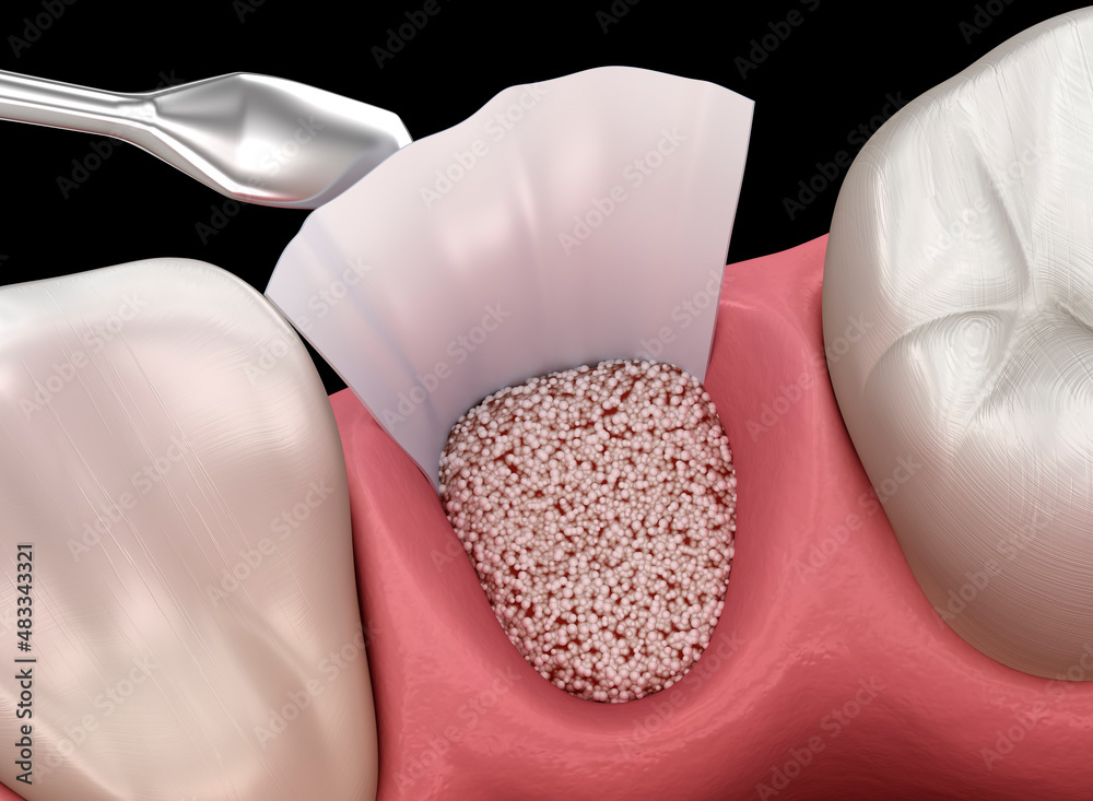 Augmentation Surgery - Adding bone after tooth extraction. 3D ...