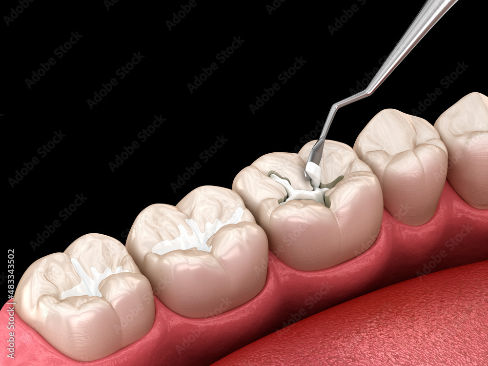 Molar tooth fissure restoration with filling. Medically accurate tooth ...