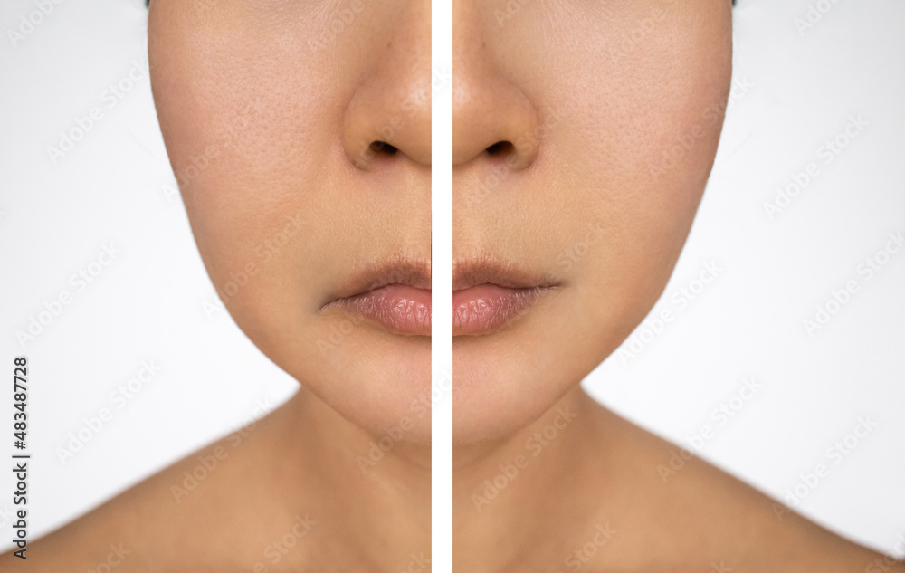 Nasolabial folds in a asian woman. Face close up. Before and after ...