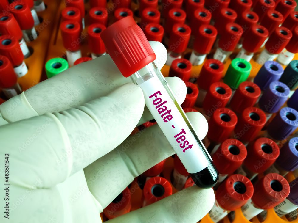 Blood sample for folic acid, folate test with lab background ... Blood sample for folic acid, folate test with lab background ...