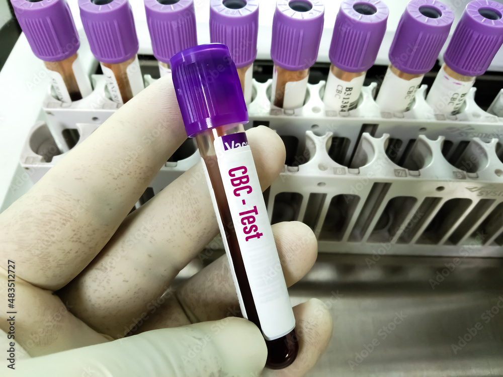 Hand holding a tube analysis labeled Complete Blood Count. CBC and in ...