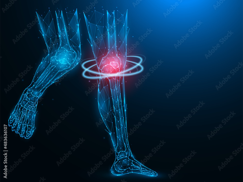 Polygonal vector illustration of human legs, painful and inflamed knee ...