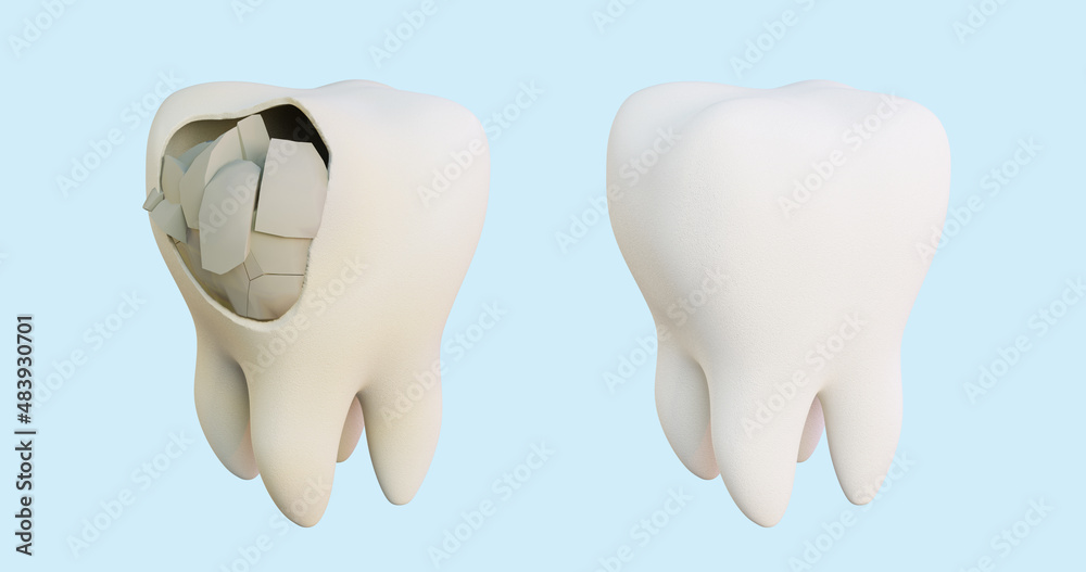 3d illustration render of tooth enamel destruction spot, caries, dentin ...