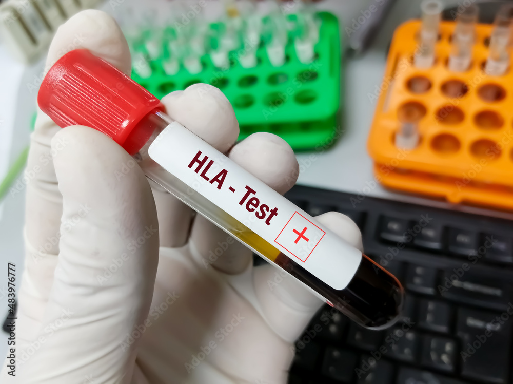 Test tube with blood sample for HLA (Human Leukocyte Antigen) test ...