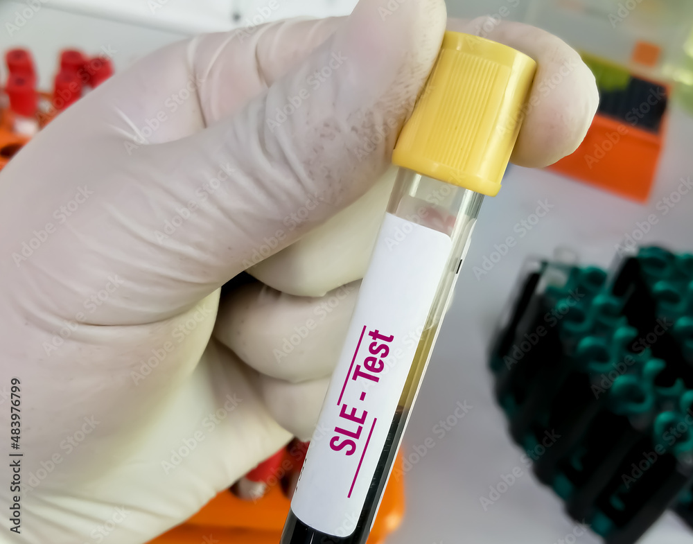 Blood sample for Systemic lupus erythematosus (SLE) test. autoimmune ...