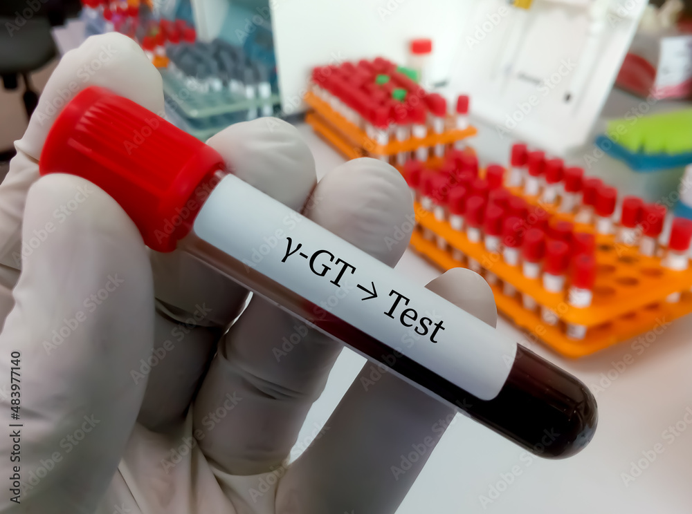 Blood sample for Gamma-glutamyl transferase or Gamma GT test, Liver ...