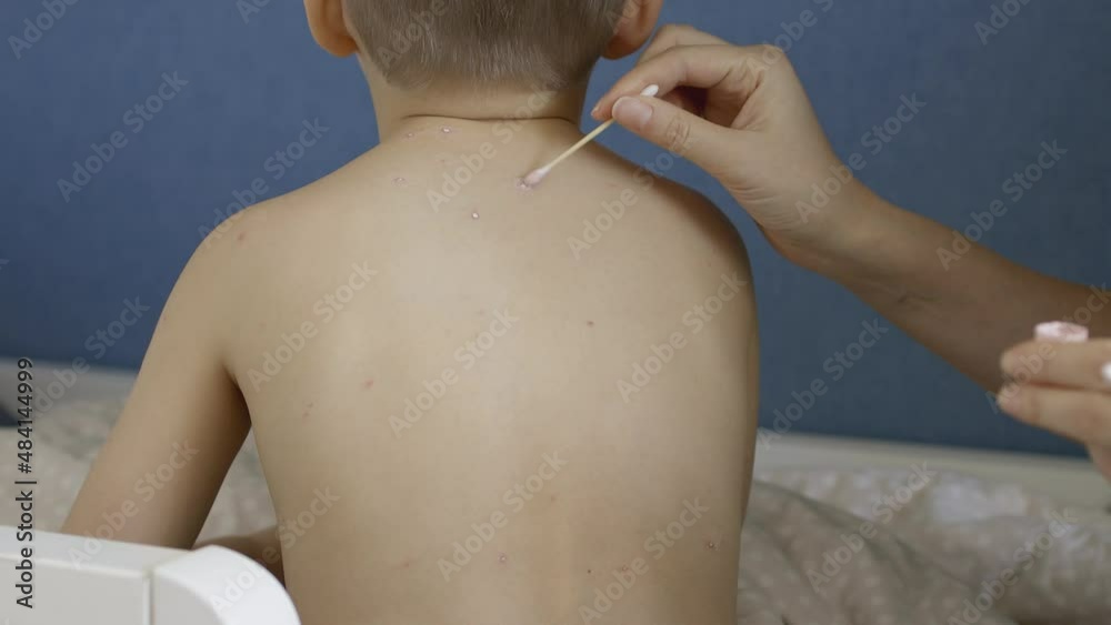 Mother applying antiseptic cream onto boy skin. Varicella virus or ...