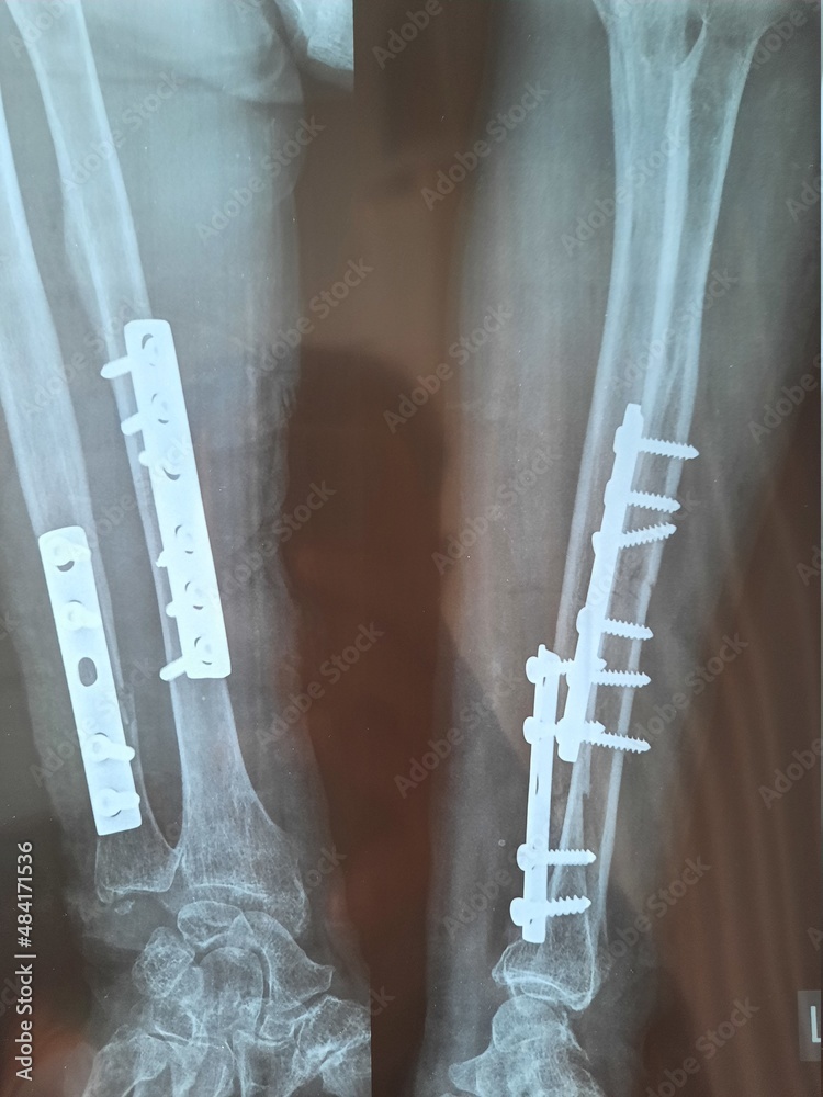 broken bone x-ray fracture patients Stock Photo | Adobe Stock