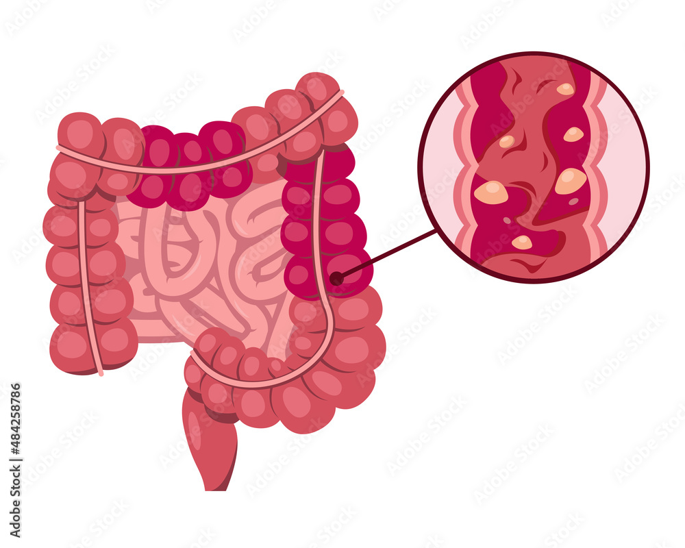 Human small and large intestine diseases. Inflammation or infection ...