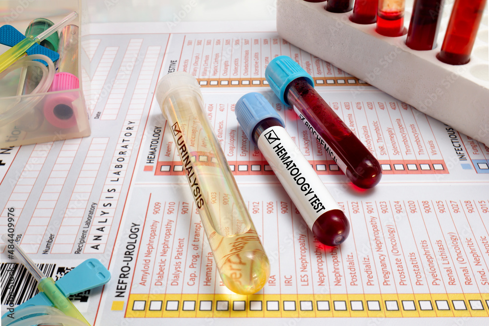 Blood tubes and urine sample for Medical test in the laboratory. Tubes ...