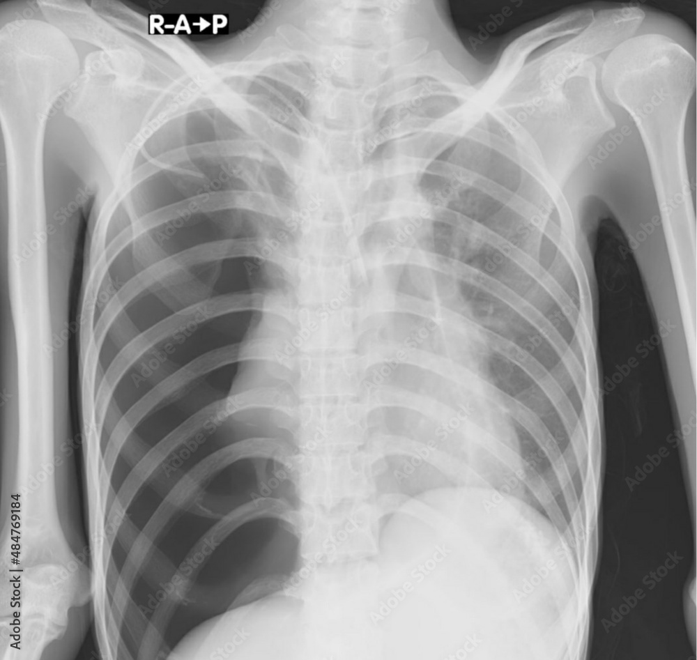 Poster x ray image of right tension pneumothorax and double lumen tube ...