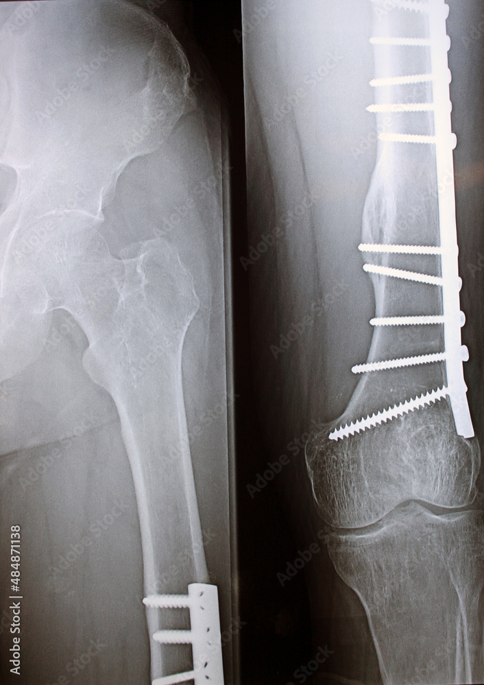 Plain X ray on the left femur that shows united mid shaft left femur ...