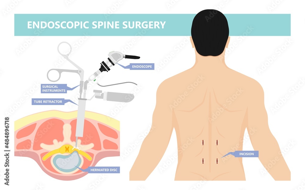 Vetor do Stock: Endoscopic spine surgery micro facet syndrome Bone ...