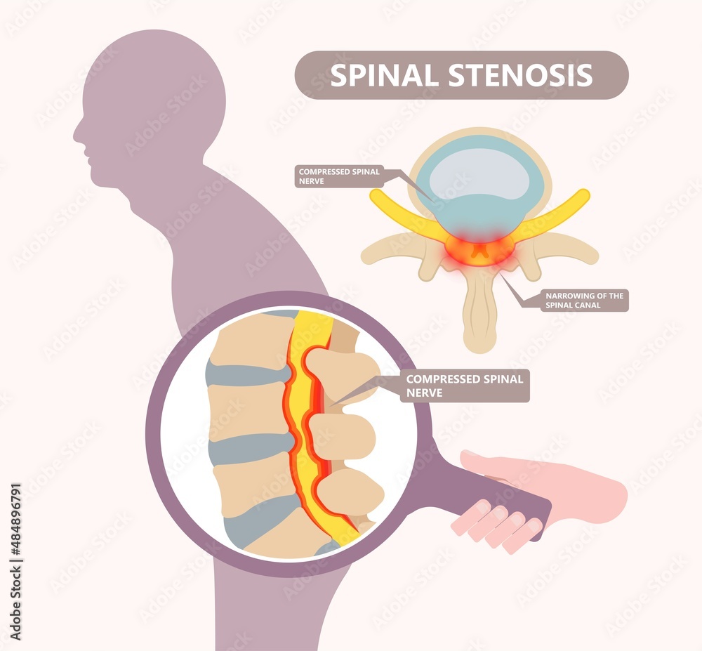 Spinal stenosis a narrowing of the spaces of the spine that causes ...