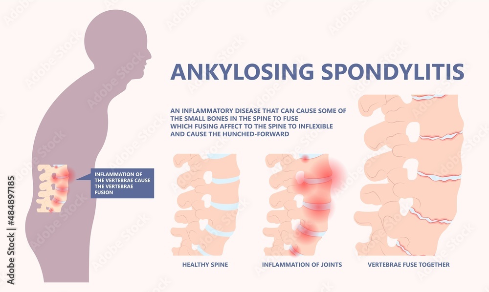 Ankylosing Spondylitis osteoporosis Skeletal pelvis Stiffness chronic ...