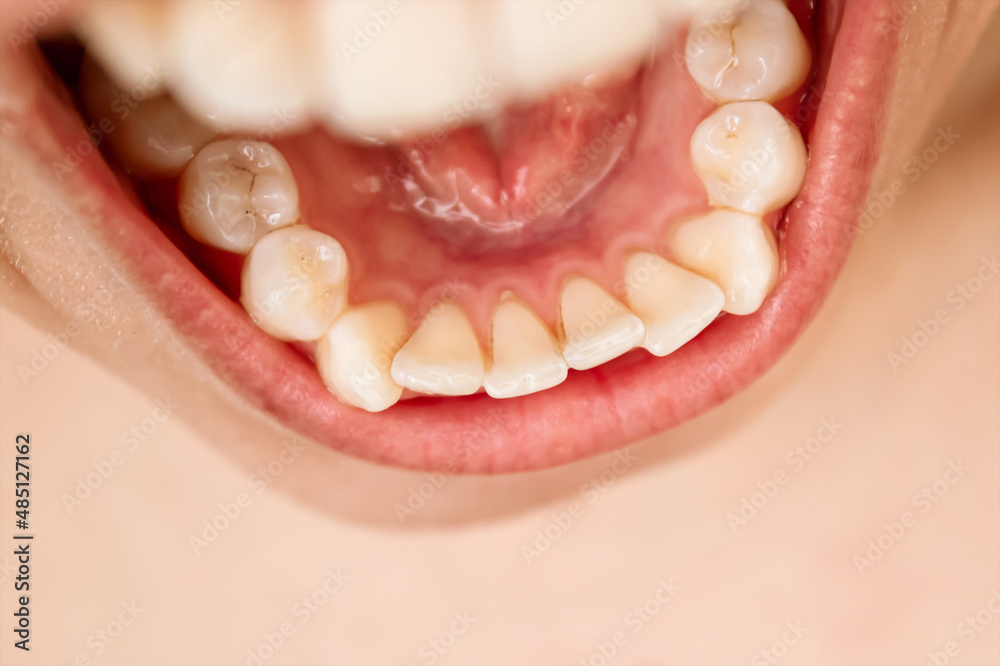 Close-up of the inside of the teeth with tartar. A person opens his ...