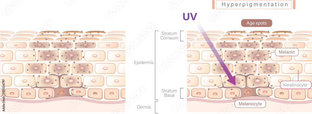 Skin structure illustration of hyperpigmentation and melanocyte with ...
