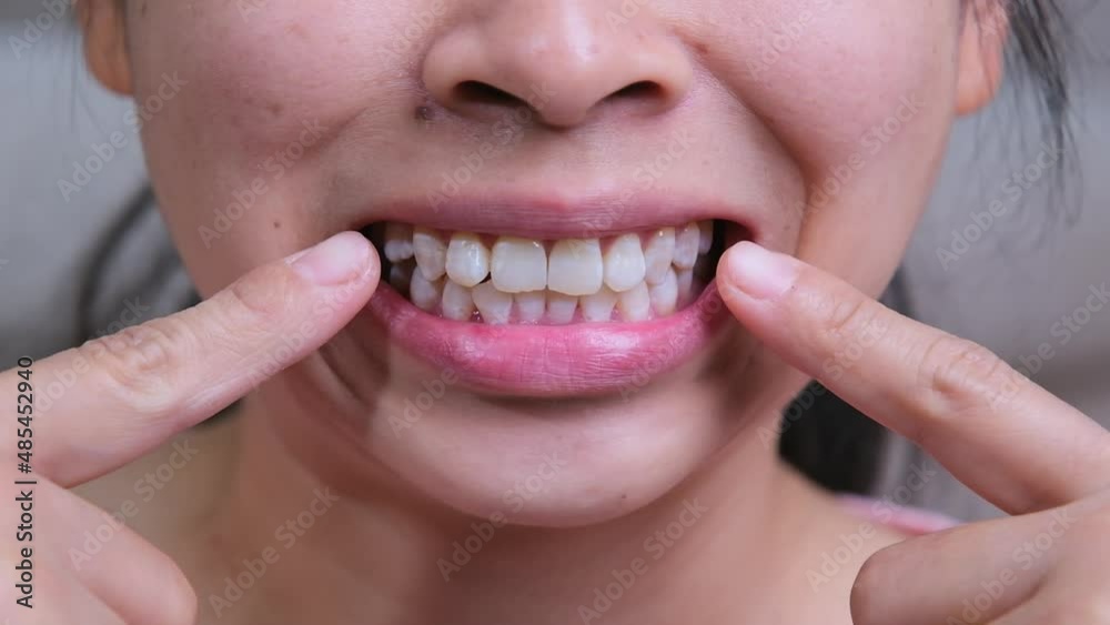 Asian woman smiles revealing white tooth spot, fluorosis in female ...
