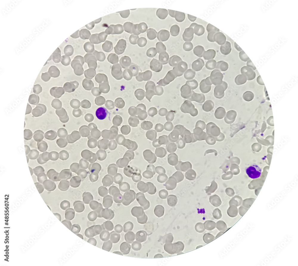 Blood smear microscopic show Reactive lymphocytes and Neutropenia ...
