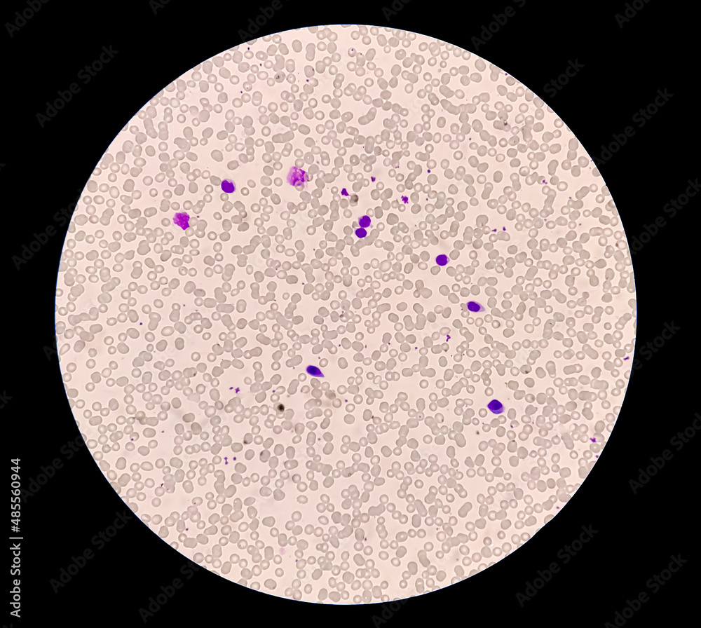 Blood smear microscopic show Reactive lymphocytes and Neutropenia. foto ...