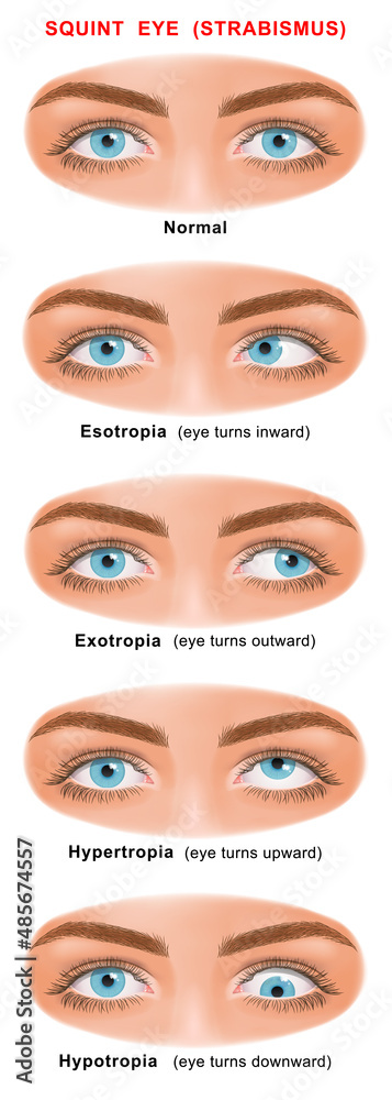 Strabismus or crossed eyes types - esotropia, exotropia, hypertropia ...