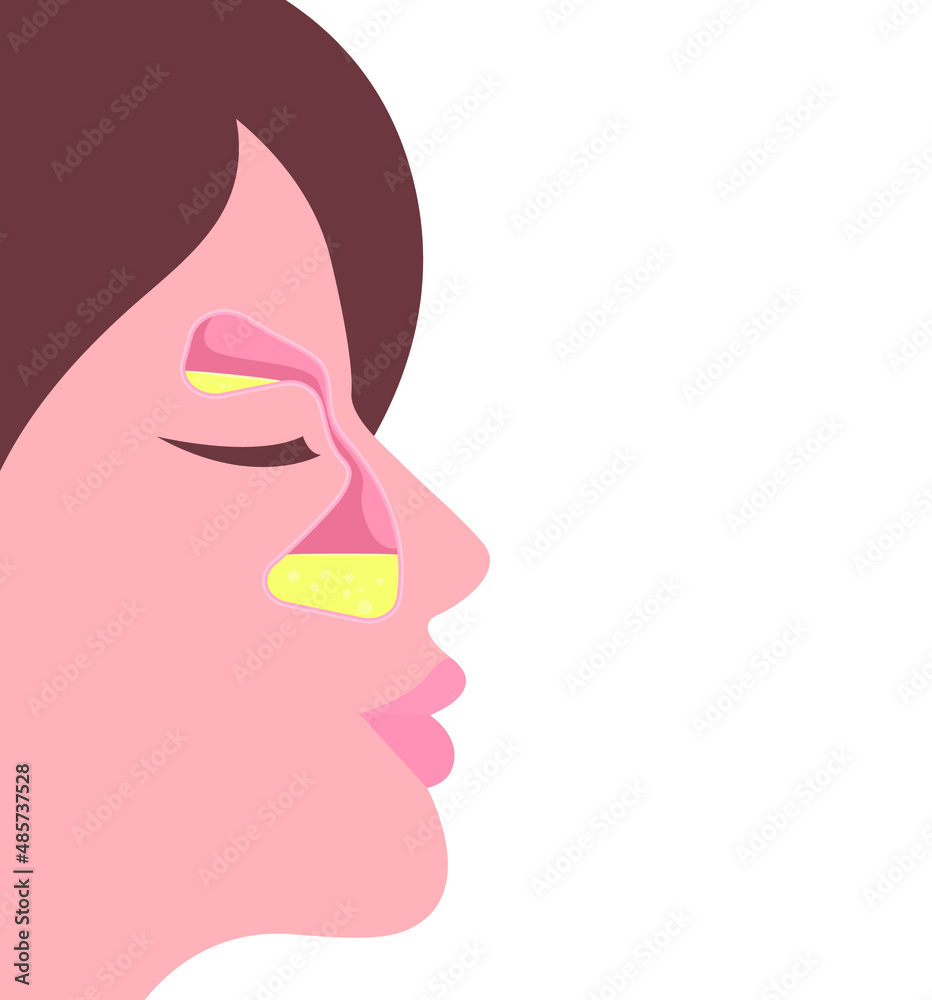 Maxillary and frontal sinuses on a woman's face in profile. Vector ...