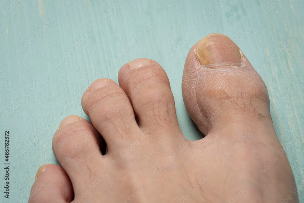 Toenails with fungus problems,Onychomycosis, also known as tinea ...