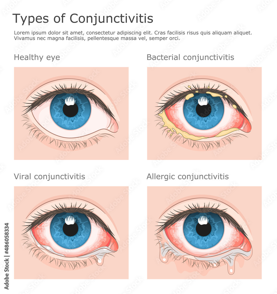 Three types of conjunctivitis and healthy eye medical vector ...