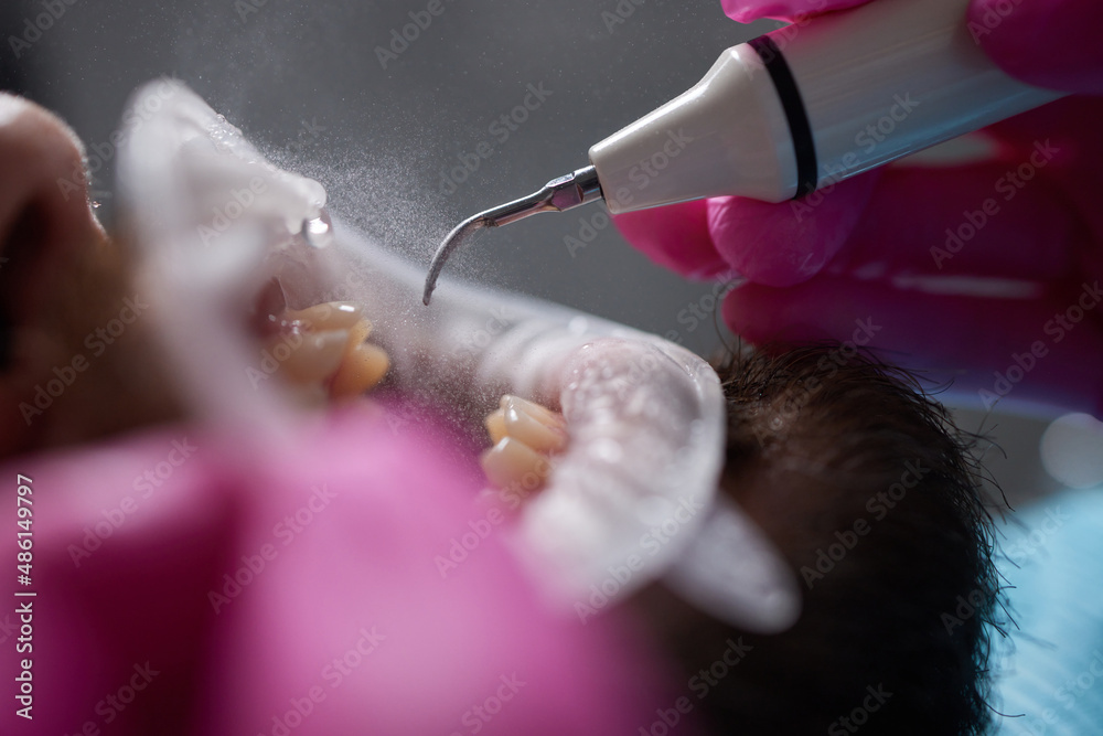 Macro photography. Top view on cleaning process in patient's mouth ...