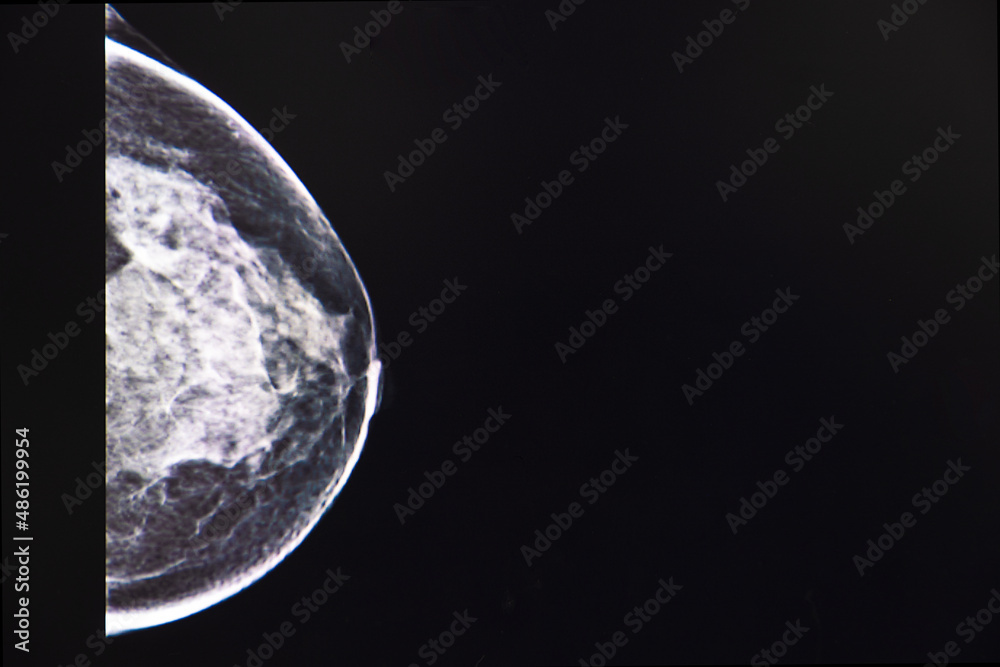 Breast Mammography, X-ray of woman's breast for early identification of ...