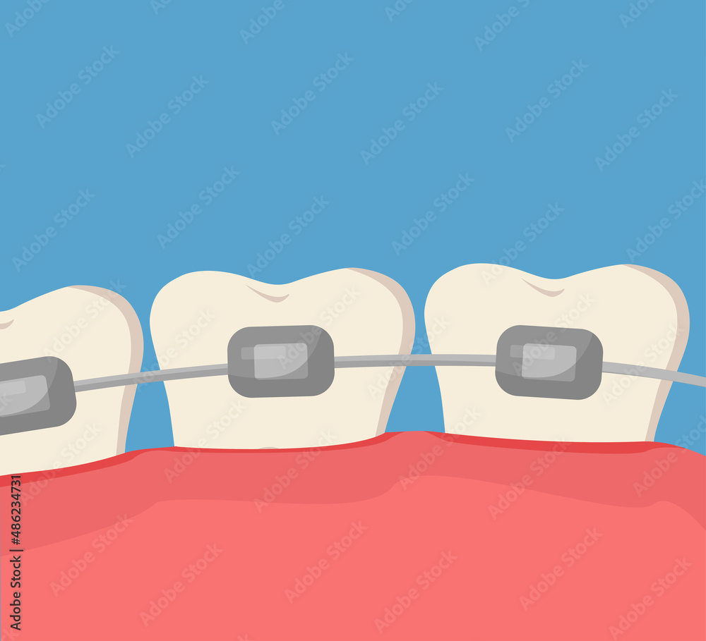 The concept of teeth alignment with braces. Simple teeth in a row ...