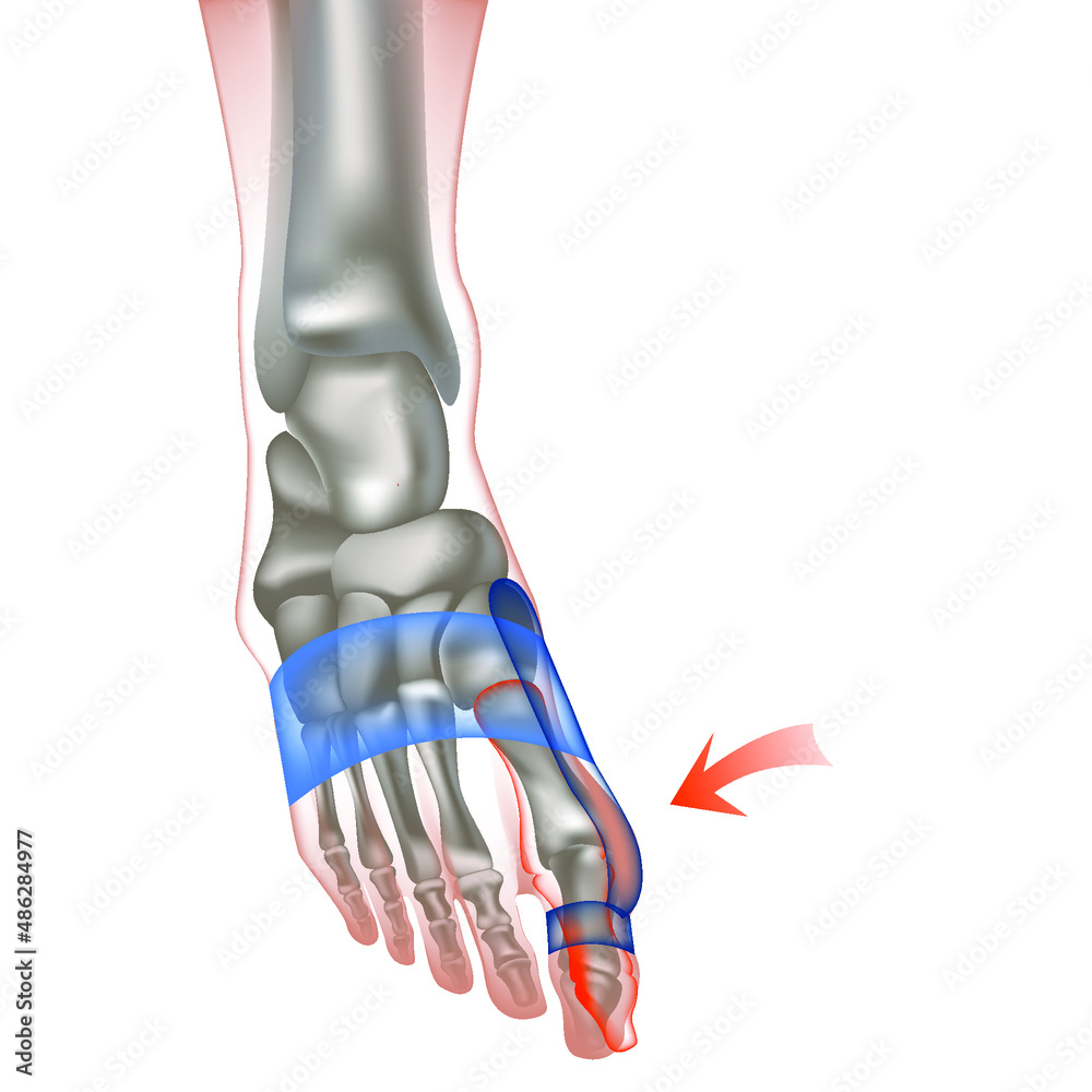 Vetor de Hallux valgus of the human foot. Protruding thumb bones. Bus ...