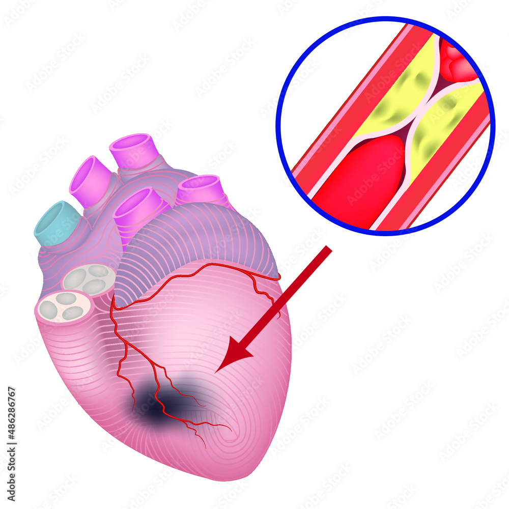 ischemia of the heart. Vascular atherosclerosis. damage to the coronary ...