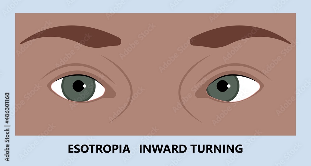 Diplopia double vision test exam brain nerve dry eye palsy gravis ...