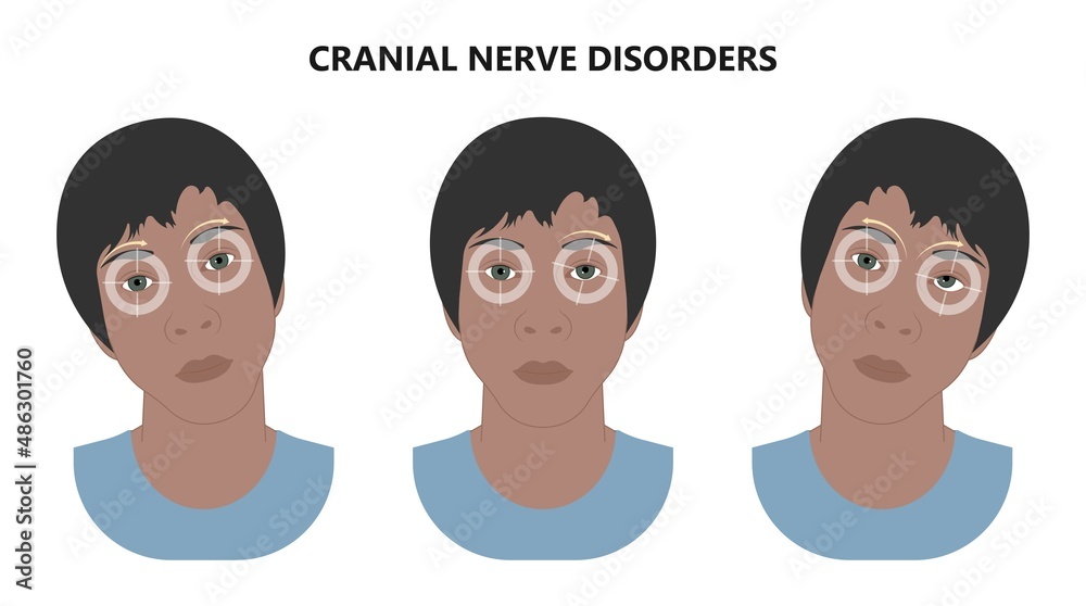 Plakat Diplopia double vision test exam brain nerve dry eye palsy ...