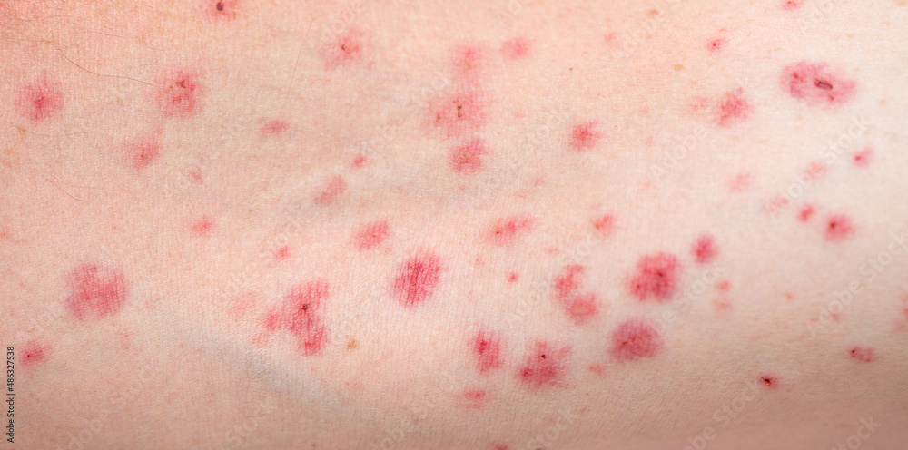 Stockfoto Spots on human skin. Rash from infection. Allergies and ...