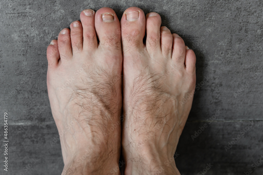 male feet with fungus and different dermatological problems close-up on ...