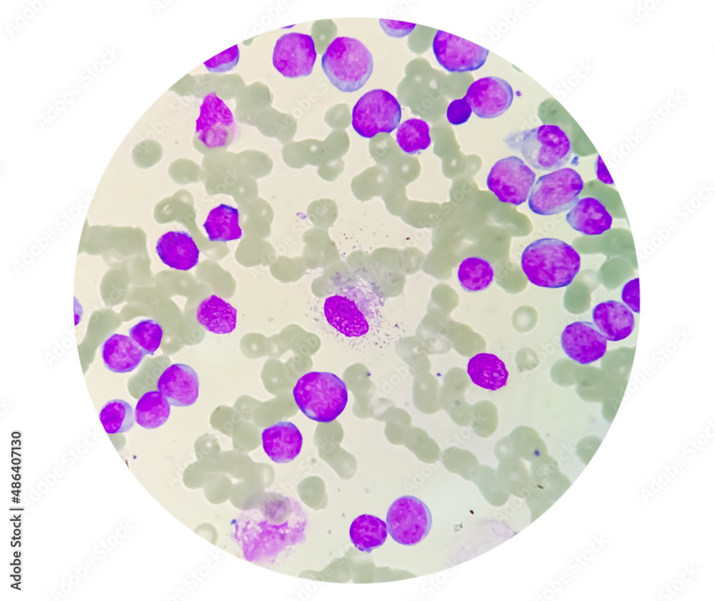 Blood Cancer, Leukemia Awareness. Photomicrograph of bone marrow ...