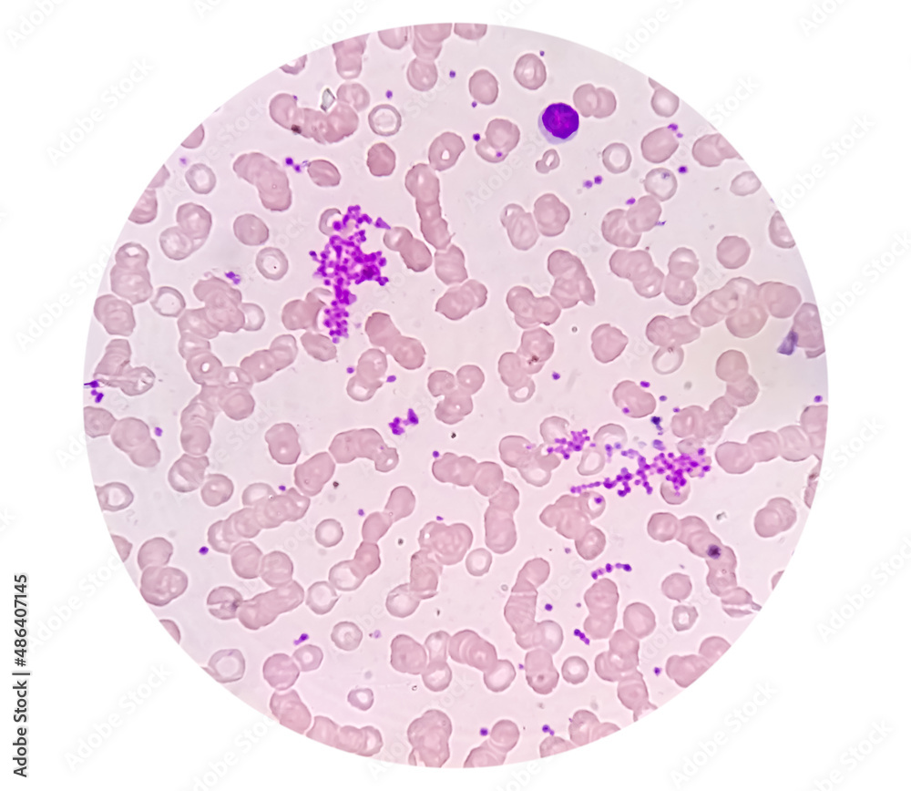 Eessential thrombocytosis blood smear showing abnormal high volume of ...