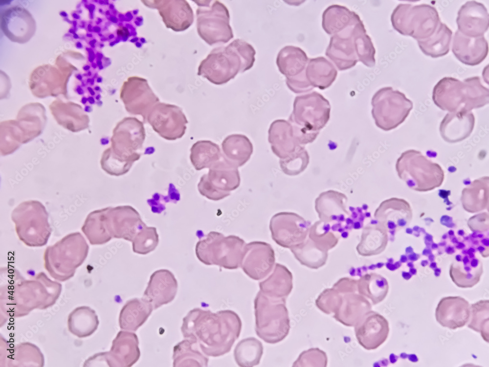 Stockfoto Eessential thrombocytosis blood smear showing abnormal high ...