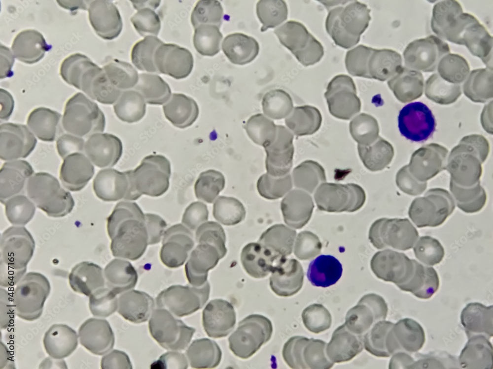 Blood smear microscopic show Reactive lymphocytes and Neutropenia ...