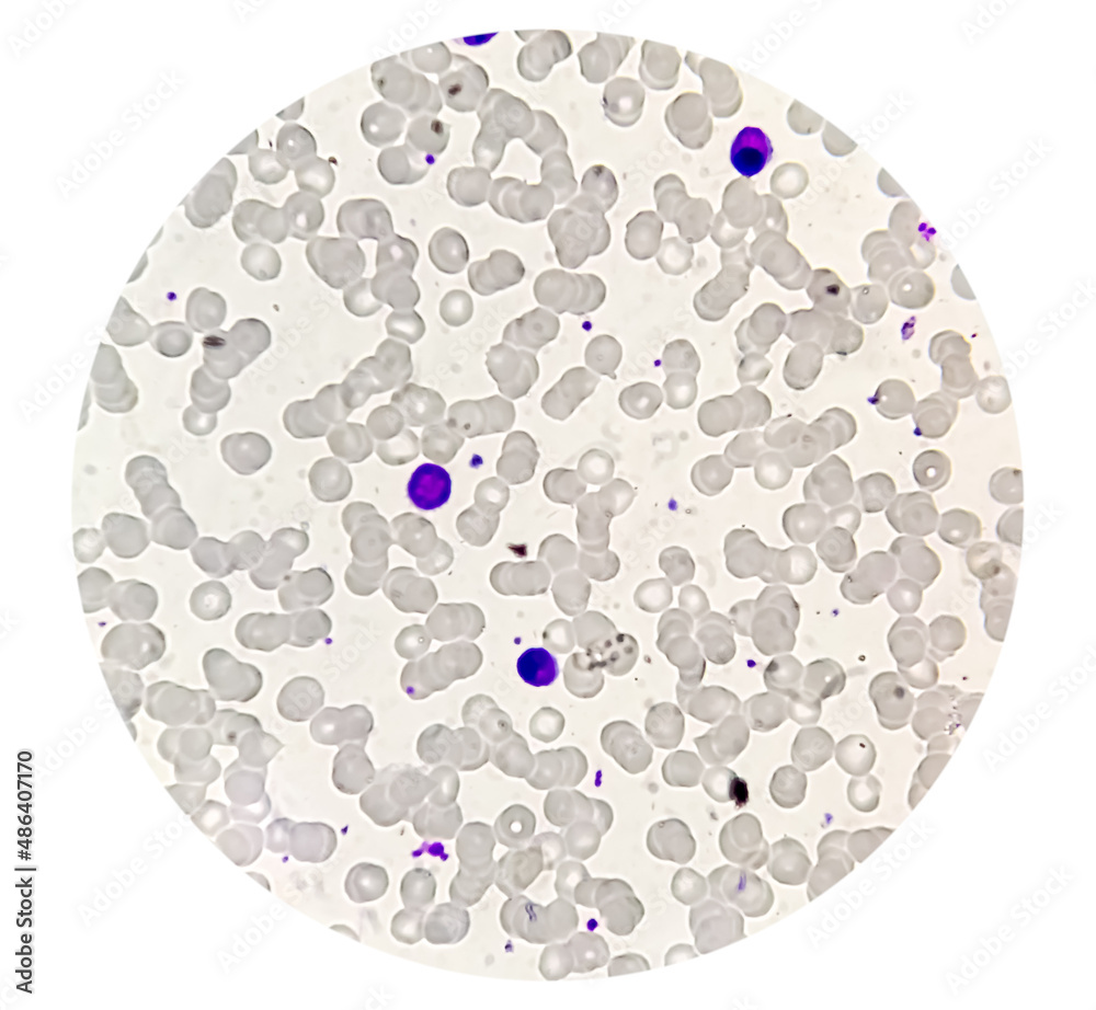Blood smear microscopic show Reactive lymphocytes and Neutropenia ...