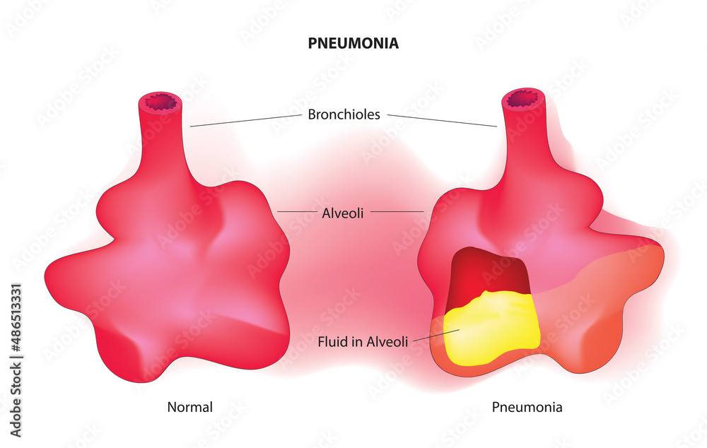 pneumonia in alveoli, alveolar fluid (fluid in alveoli) Stock Vector ...