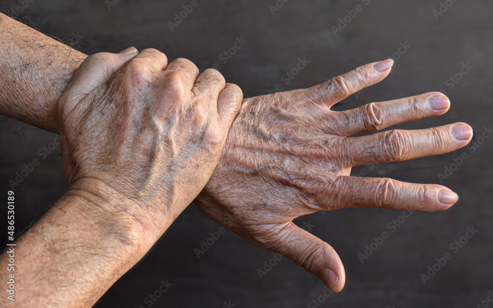 Age spots on hands. They are brown, gray, or black spots and also ...
