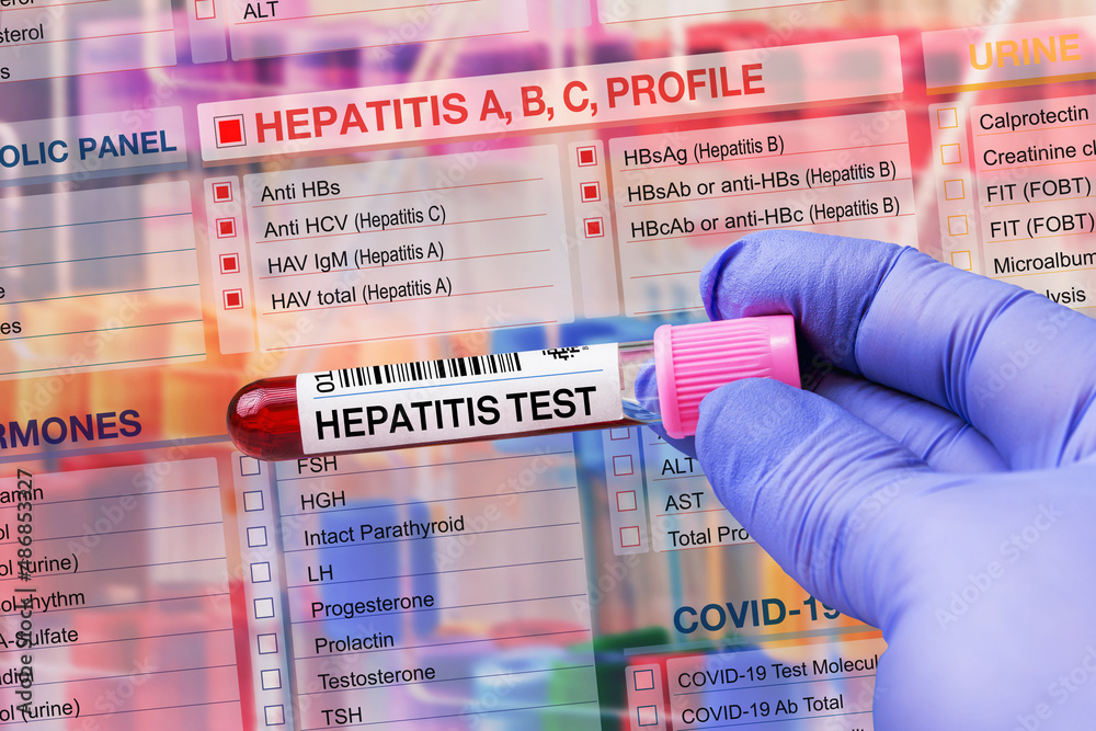 Foto de Blood tube test with requisition form for analysis Hepatitis ...