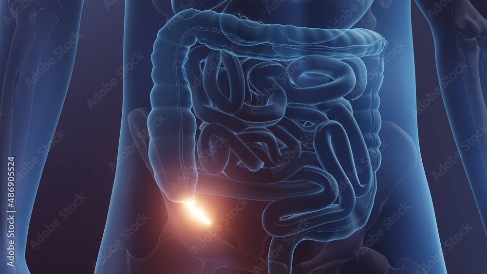 Appendix in human body, Appendicitis concept Stock Illustration | Adobe ...