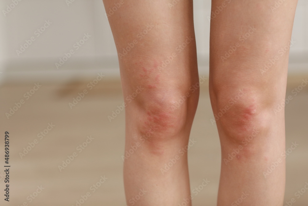 Foto de skin allergies, legs skin women. Closeup of red pustules on a ...