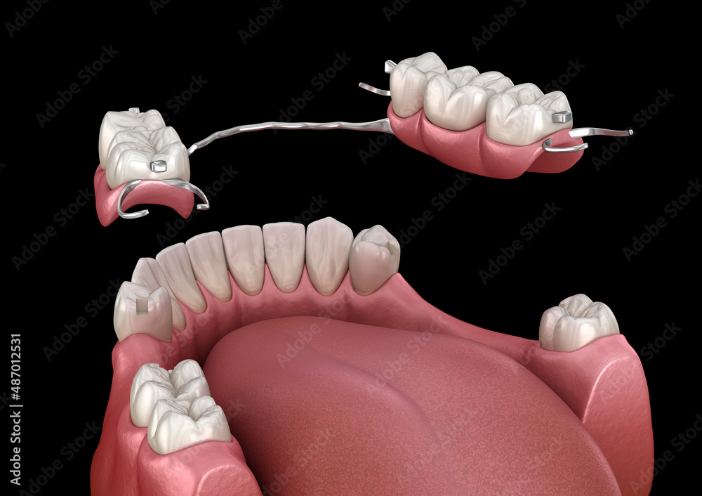 Removable partial denture, mandibular prosthesis. Medically accurate 3D ...