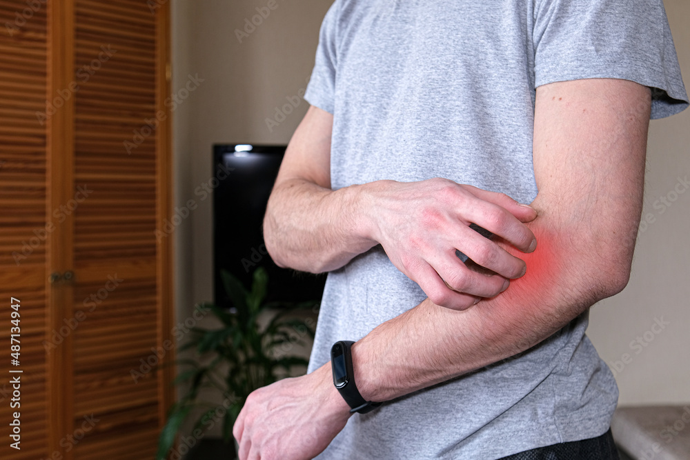A man scratching an itchy hand. Dermatitis, eczema, allergies ...