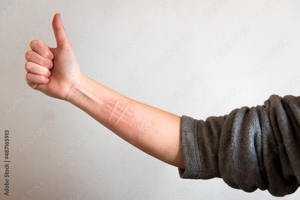 Fotografia do Stock: Detalle de un brazo con síntomas de una condición ...